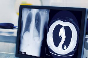 ClearRead XRay - Riverain