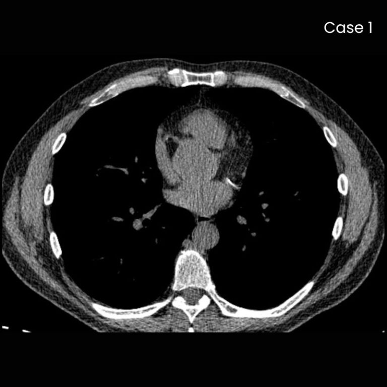ClearRead CT - Riverain